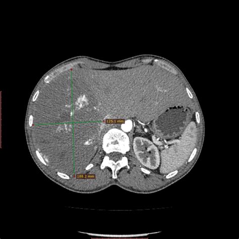 Vessel Embolization As Alternative And Effective Method Of Treatment Of Non Cardiac Diseases