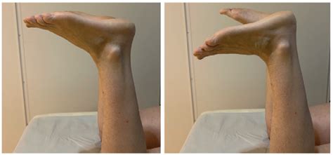 Matles Test In The Left Picture The Ankle Has An Anatomic Angle Download Scientific Diagram