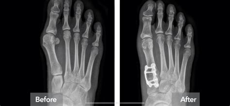 Lapiplasty Procedure In Brooklyn New York City Best Foot Doctor Ny