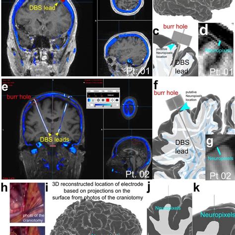 Large Scale Neural Recordings With Single Neuron Resolution Using
