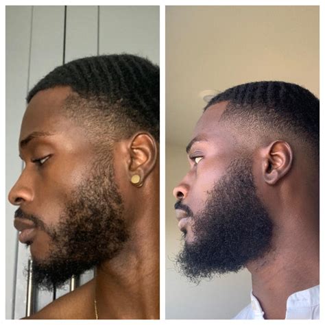 Just Grow It Out The Patches Will Fill In If You Take Care Of It