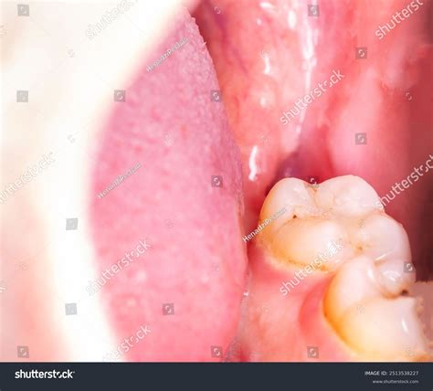 Infected Wisdom Tooth Socket