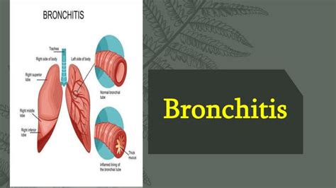 Bronchitis Definition Etiology Clinics Manifestations Pathophysiology Management Pptx