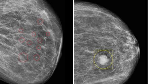 Calcification And Mass Abnormalities In Breast Mammogram Scans The Download Scientific Diagram