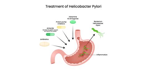 Helicobacter Pylori Infection Management Mims Hk