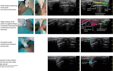 Overview Of Probe Positioning And Needle Insertion With Corresponding