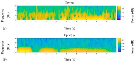 Sensors Special Issue Eeg Signal Processing Techniques And Applications