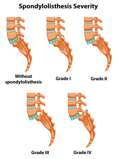 Spondylolisthesis Grading X Ray