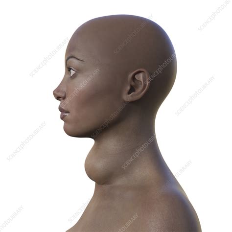 Woman With Enlarged Thyroid And Exophthalmos Illustration Stock Image F043 6084 Science
