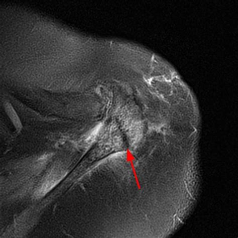 Acromial Stress Fractures After Shoulder Decompression Surgery Radsource