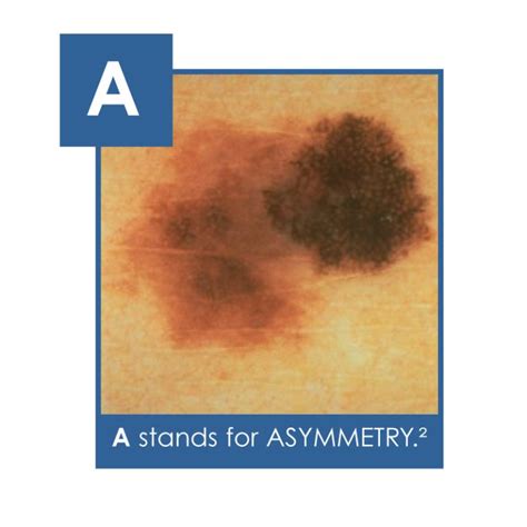 The Abcdes Of Melanoma Houston Dermatology Specialists