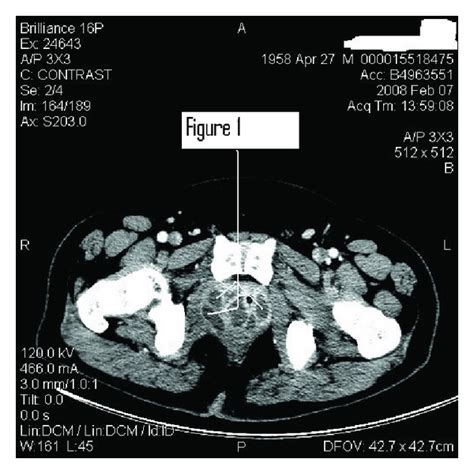 Case Report Of A Prostatic Abscess With A Review Of The Literature Pmc