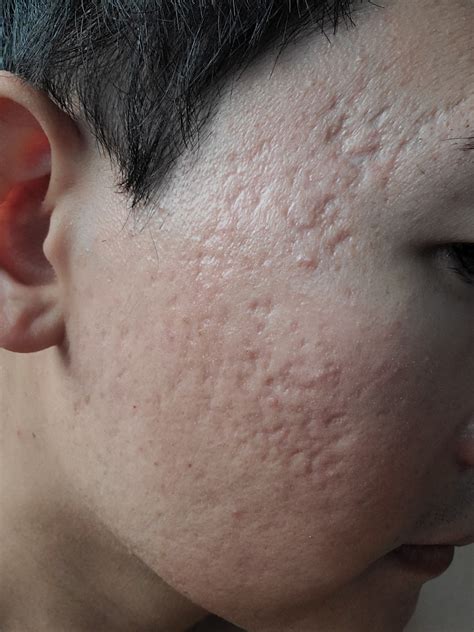 심한 여드름 흉터 치료에는 박피성 레이저로 해결