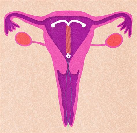 What Iud Insertion Feels Like Does Getting An Iud Hurt
