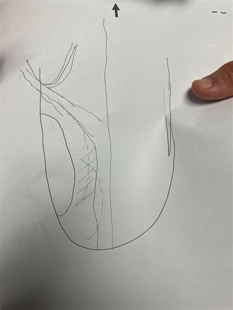 So You Re Having A Partial Glossectomy … By Scott Gordon Sep 2024