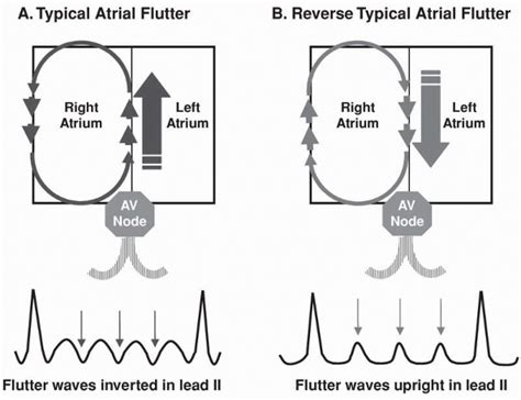 Atrial Flutter Basic And Bedside Electrocardiography 1st Edition 2009