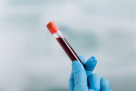 Laboratory Values And Diabetic Ketoacidosis Dka Sentinel Nurse