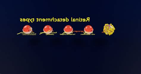 Retinal Detachment Types Eye 3d Model Superhive Formerly Blender Market