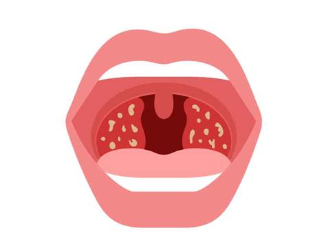 Mild Strep Throat Looks Like