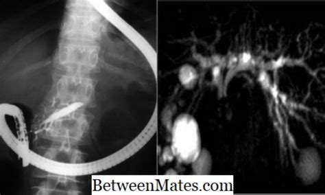 Différence entre ERCP et MRCP Différence entre 2021 Autres