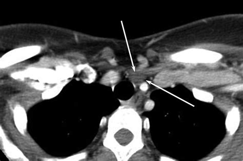 What Does Residual Thymus Mean At Wilford Shaw Blog