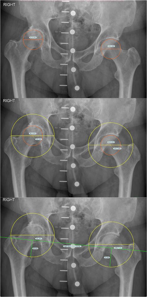 A Technical Tip For Assessing Leg Length Discrepancy In Radiographs