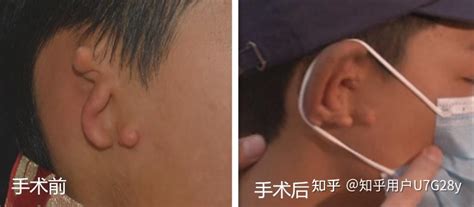 耳畸形 耳缺失孩子们上天遗忘的我们来帮你补上 知乎 耳畸形 耳缺失孩子们上天遗忘的我们来帮你补上 知乎