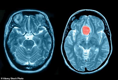 As Hundreds Of Women In The Us Prepare To Sue Over Jab Did Common