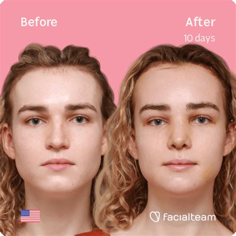 Experts In Facial Feminization Surgery — Facialteam