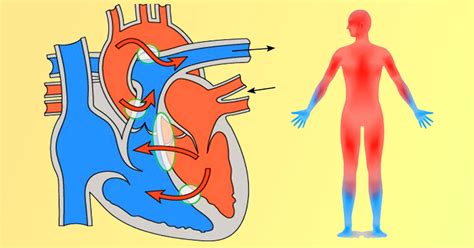 სისხლსი ცუდი მიმოქცევა გაქვთ აირიდეთ ინფარქტი ინსულტი და ათეროსკლეროზი მხოლოდ ერთი პროდუქტით