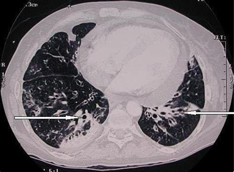 CT Scan Of The Chest Bronchial Wall Thickening And Dilatation Download Scientific Diagram
