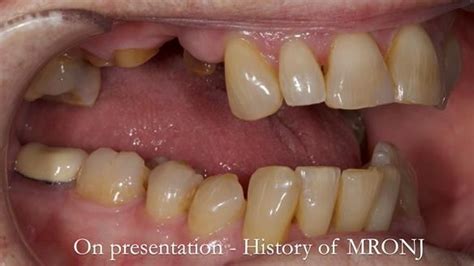 Finlays Newsletter 60 Sylvias Upper Kennedy Class 2 Mod 1 Metal Based Upper Rpd Finlay