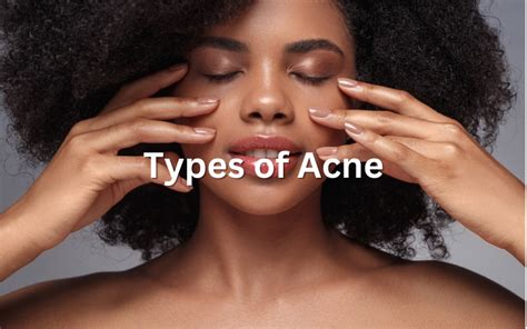Types Of Acne Kansas City