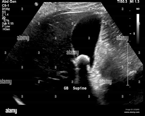 Gallstone Ultrasound