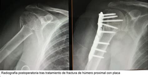 Rafi Fractura Humero Proximal