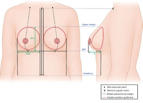 Figure 2 From Prepectoral Breast Reconstruction With Complete Implant Coverage Using Double