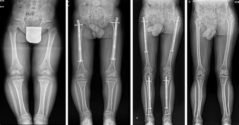 Acondroplasia Radiografia