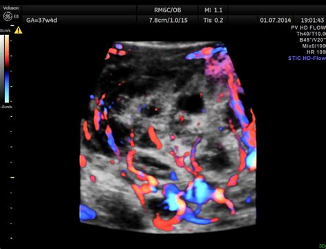 Placental Mass Lesion Placental Mesenchymal Dysplasia Pmd Looking
