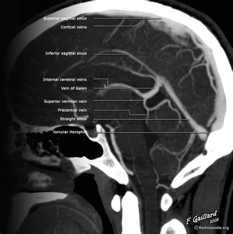 Confluence Of Sinuses Radiology Reference Article Radiology Medical