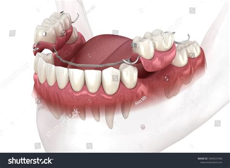 Removable Partial Denture Mandibular Prosthesis Medically Stock