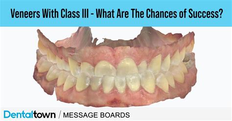 Dentaltown On Linkedin Patient Has A Class Iii Underbite And Does Not Really Want To Do…