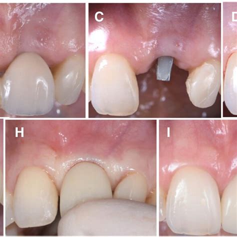Soft Tissue Dehiscence And Fenestration Caused By Errors In Angulation Download Scientific