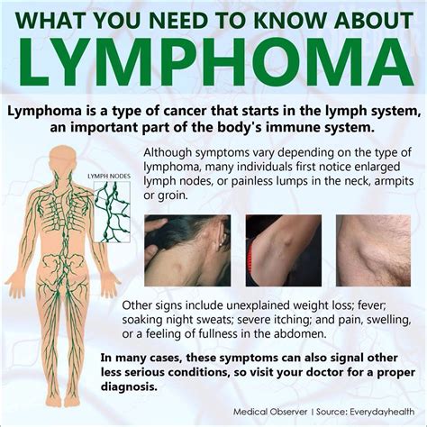 Best 13 Non Hodgkin Lymphoma Causes Symptoms And Treatments Artofit