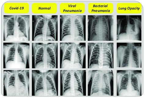 sample x ray images electronics 2022 11 x for peer review 7 of 21