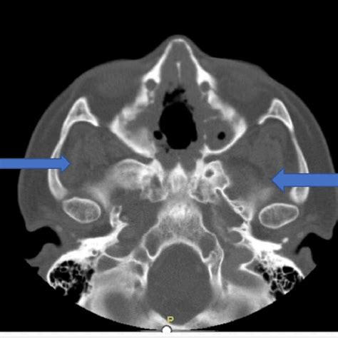There Is An Irregular Appearance Of The Medial Bilateral Maxillary Download Scientific Diagram