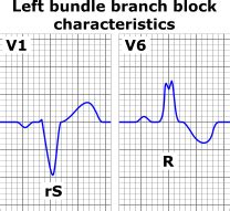Bundle Branch Block Study Guide Definitions Key Terms Flashcards Quizlet