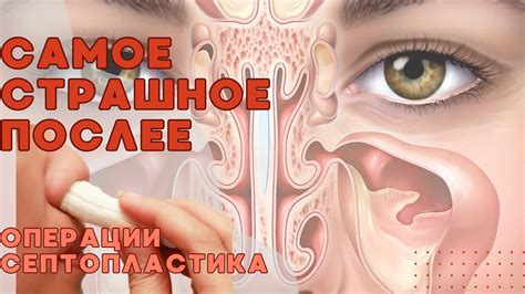 Септопластика. Удаляем тампоны и сплинты из носа! - YouTube