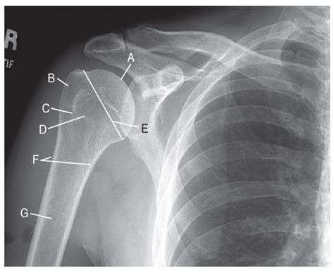 X Ray Anatomy Humerus Ap External Rotation True Ap Diagram Quizlet