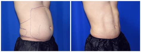 Top 3 Liposuction Areas For Men Houston Lipo Center