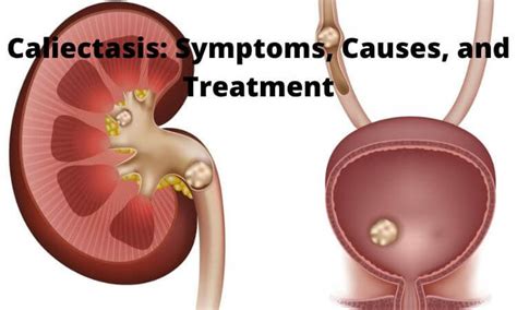 Caliectasis Symptoms Causes And Treatment Kfanhub